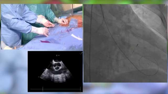 A new evolution: TAVR for aortic regurgitation with the JenaValve ...