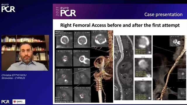 Challenging TAVI cases