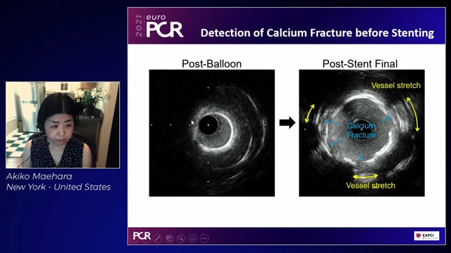 Complex PCI in coronary calcified lesions, the right tools and techniques
