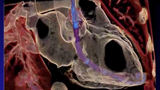 Complex treatment of the post MI ventricular septal defect