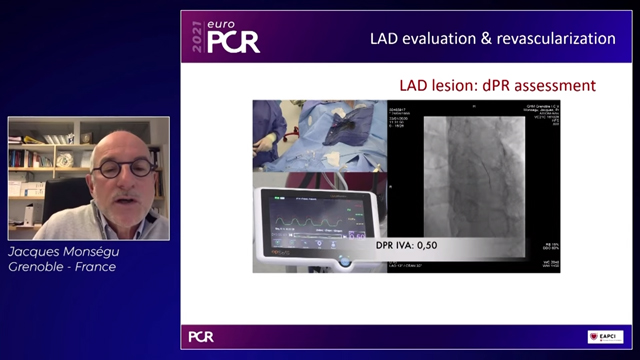 Coronary physiology in STEMI: is OpSens OptoWire III a game-changer in ...