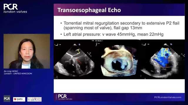 Emergent transcatheter therapy