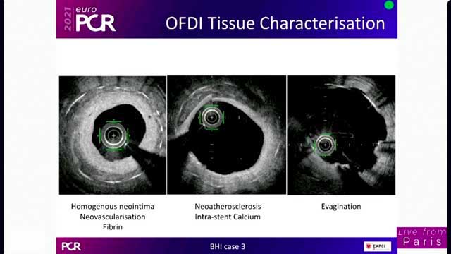 Clinical applications of IVUS, OCT and other intracoronary imaging ...