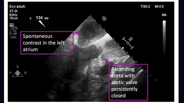 Complex PCI in complex patients
