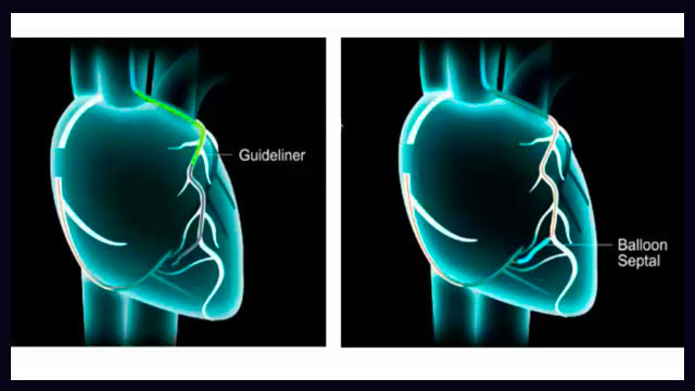 CTO anterograde approach