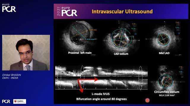 LM PCI in complex scenarios