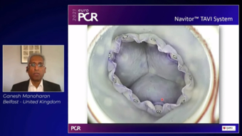 TAVI (Transcatheter aortic valve implantation)