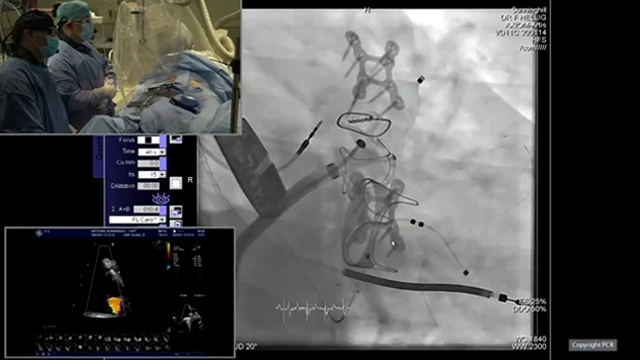 Left atrial appendage closure (LAAc) for stroke prevention - Session ...