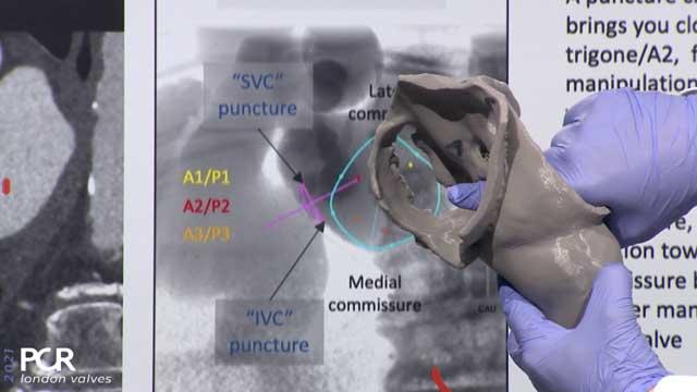 Mitral anatomy and imaging essentials