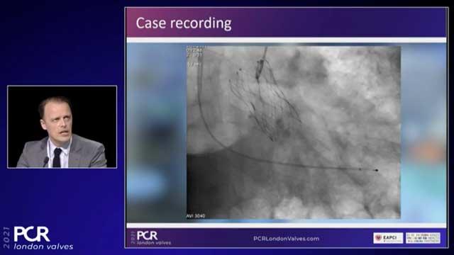 The Navitor with FlexNav TAVI system: when smooth implantability allows ...