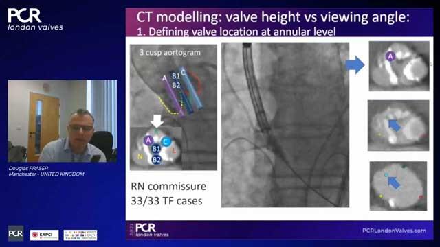 Pacemaker implantation after TAVI