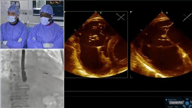 Percutaneous tricuspid valve repair: how to perform it - Session with ...