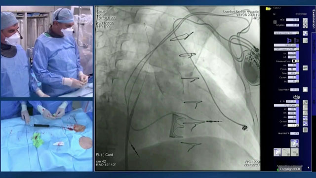 Percutaneous tricuspid valve replacement: how to perform it - Session ...