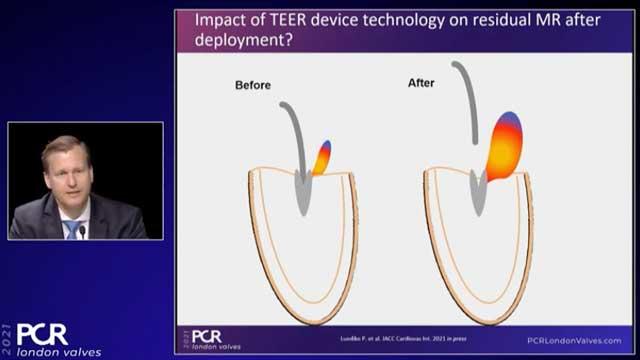 Seeing is believing: predictable and durable treatment of mitral ...