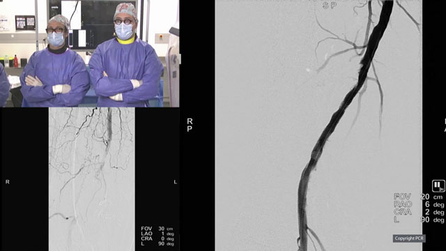 SFA and popliteal interventions (part 2) - Session with LIVE demonstration