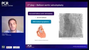 TAVI (Transcatheter aortic valve implantation)