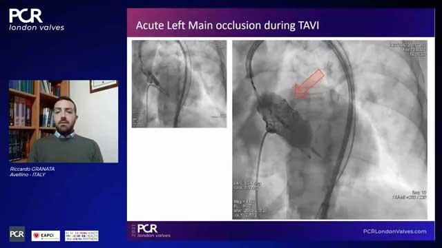 TAVI complications
