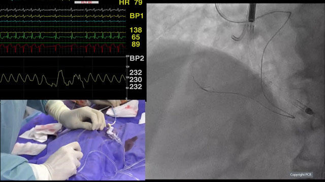 Complex PCI with left ventricular support - Session with LIVE case