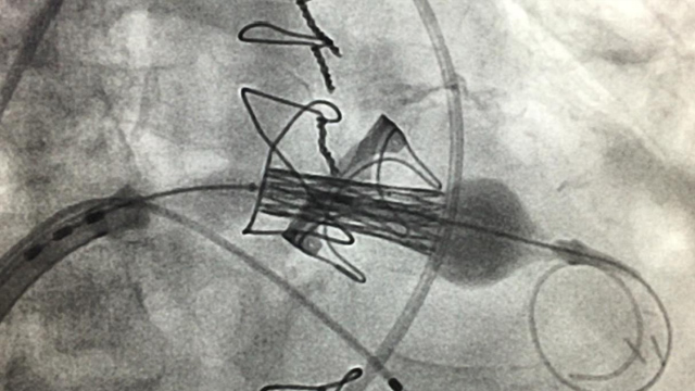 All you need to know before starting a mitral valve-in-valve or valve ...