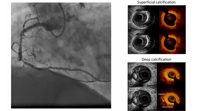 Atherectomy devices: when and how to use them?