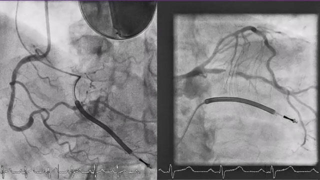 Beyond the guidelines of STEMI management: challenges in Southeast Asia