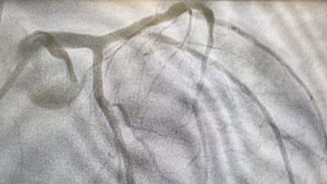 Bifurcation lesion - Tools, devices and techniques