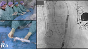 TAVI (Transcatheter aortic valve implantation)