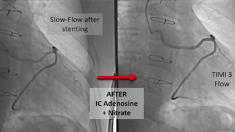 NSTEMI (Non-ST-segment elevation myocardial infarction)