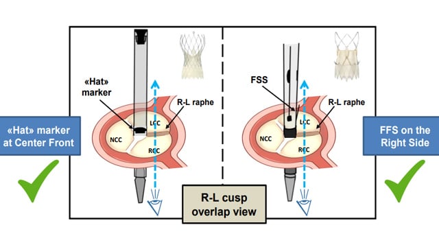 Clinical outcomes after TAVI: Session 1