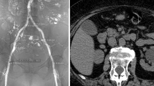 Clinical outcomes after TAVI: Session 2