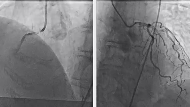 Complications during and after primary PCI