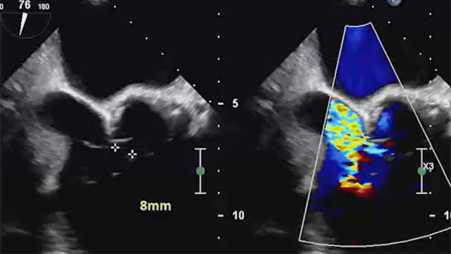 Complications during TAVI procedures