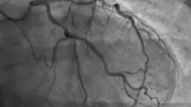 Dissection and coronary perforation: how to treat