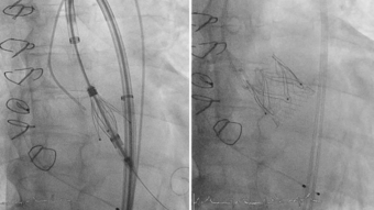 TAVI (Transcatheter aortic valve implantation)