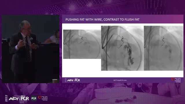 How to avoid and manage complications - Rupture and perforation