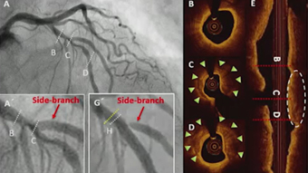 Calcified lesions