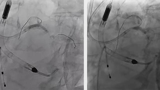 Left main and bifurcation PCI in NSTEMI