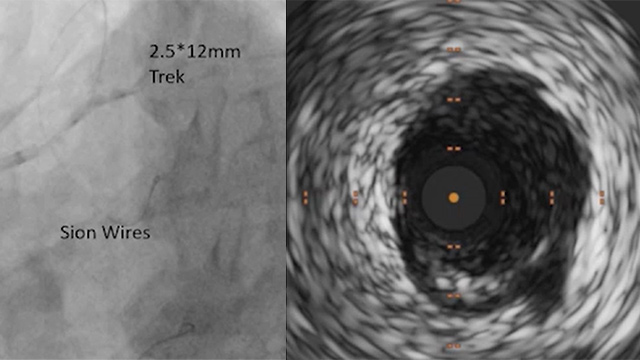 Left main PCI in different technical and anatomical scenarios