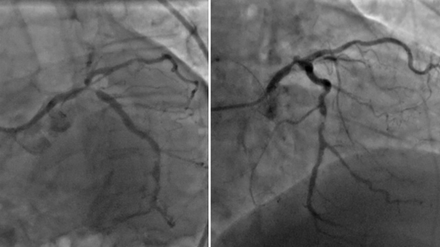 Left main multivessel disease and other coronary interventions