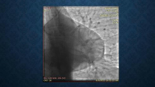 Left main and multivessel disease - Session 2