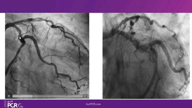 Managing a high bleeding risk patient undergoing PCI