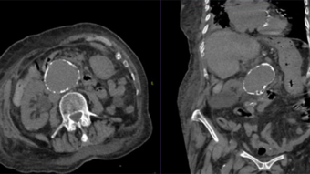 TAVI (Transcatheter aortic valve implantation)