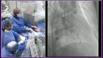 TAVI (Transcatheter aortic valve implantation)