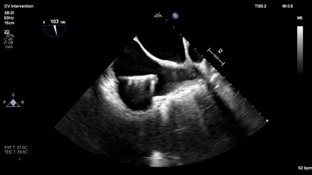 Patient selection for tricuspid valve interventions