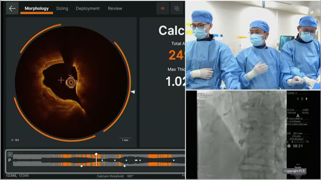 PCI calcified lesion - Session with LIVE case