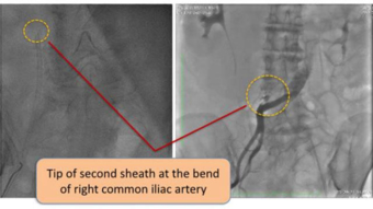 Stable CAD (Coronary artery disease)
