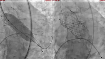 TAVI (Transcatheter aortic valve implantation)