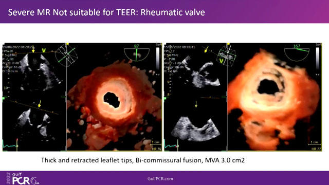 Severe mitral and tricuspid regurgitation