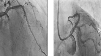 ST-segment elevation myocardial infarction (STEMI)