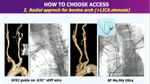 Tailored procedure for carotid angioplasty